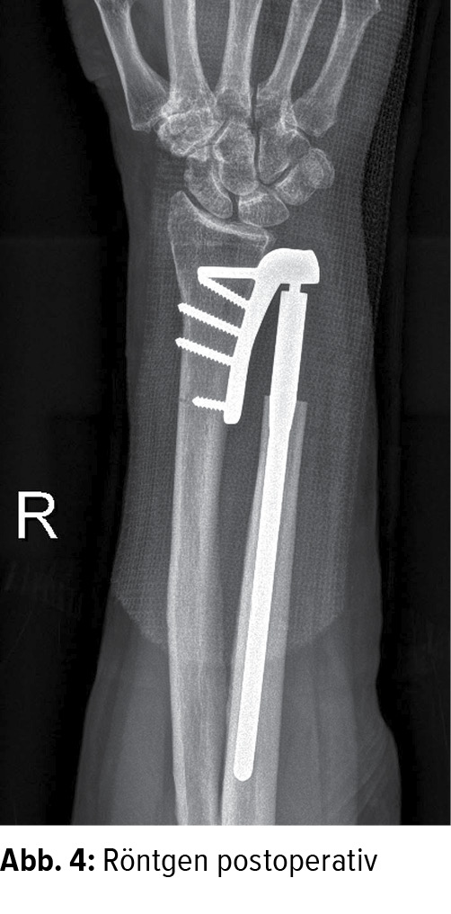 Distaler Ellenersatz durch eine Scheker-Prothese - Orthopädie ...