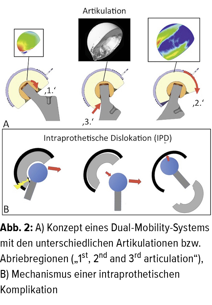 Stellenwert des Dual-Mobility-Systems in der Hüfttotalendoprothetik ...