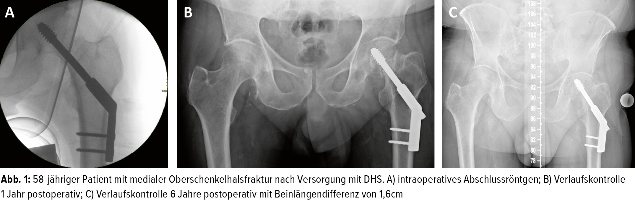 Komplikationen nach intramedullärer Versorgung per- und subtrochantärer Frakturen - Orthopädie ...