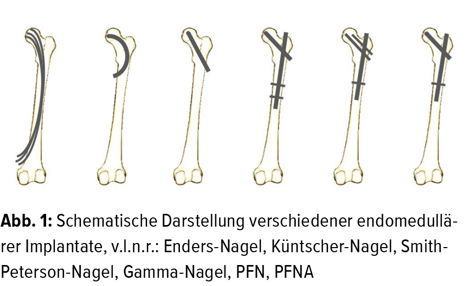 Komplikationen nach PFNA: erkennen und vermeiden! - Orthopädie ...