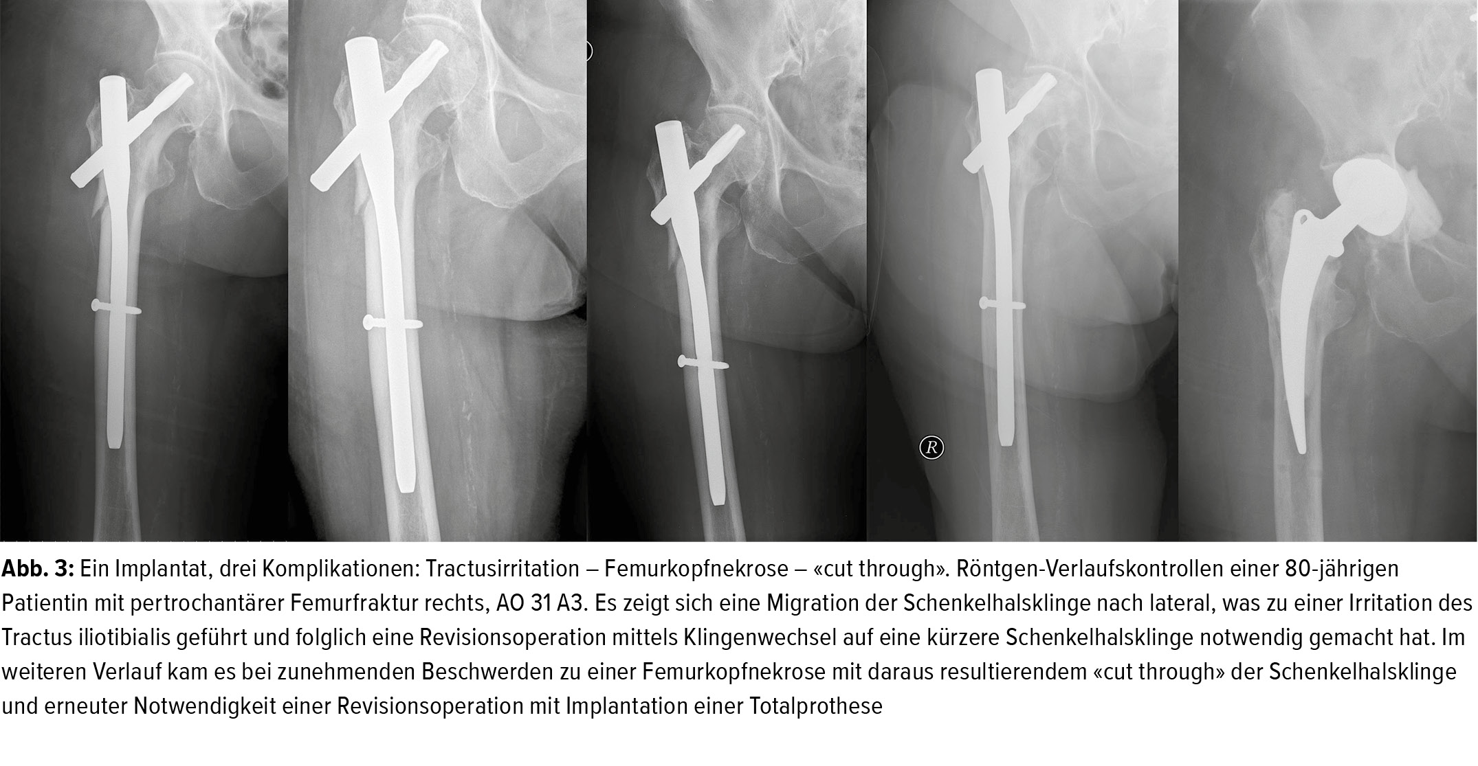 Komplikationen nach PFNA: erkennen und vermeiden! - Orthopädie ...