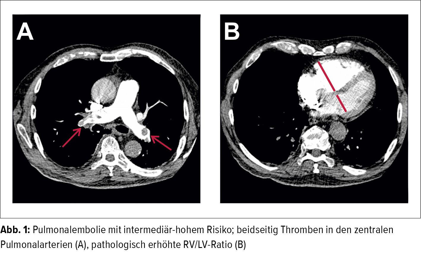 Lysetherapie – Indikationen bei Pulmonalembolie? - Kardiologie ...