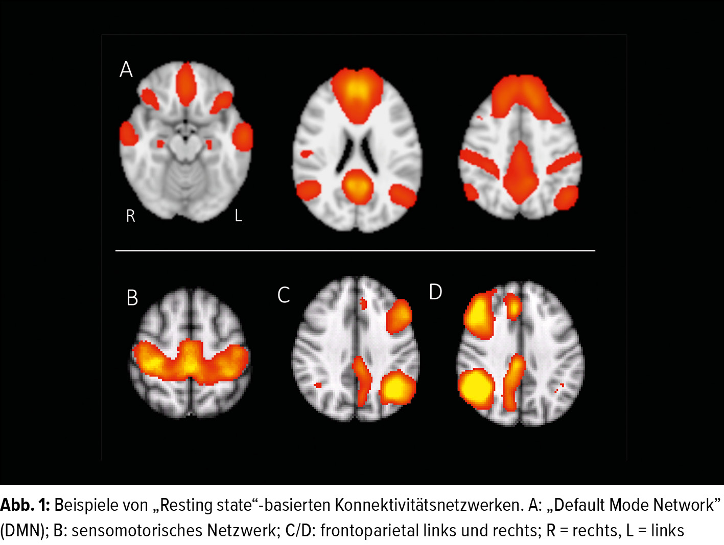 „Resting state“-fMRT – Potenzial und Herausforderung bei ...