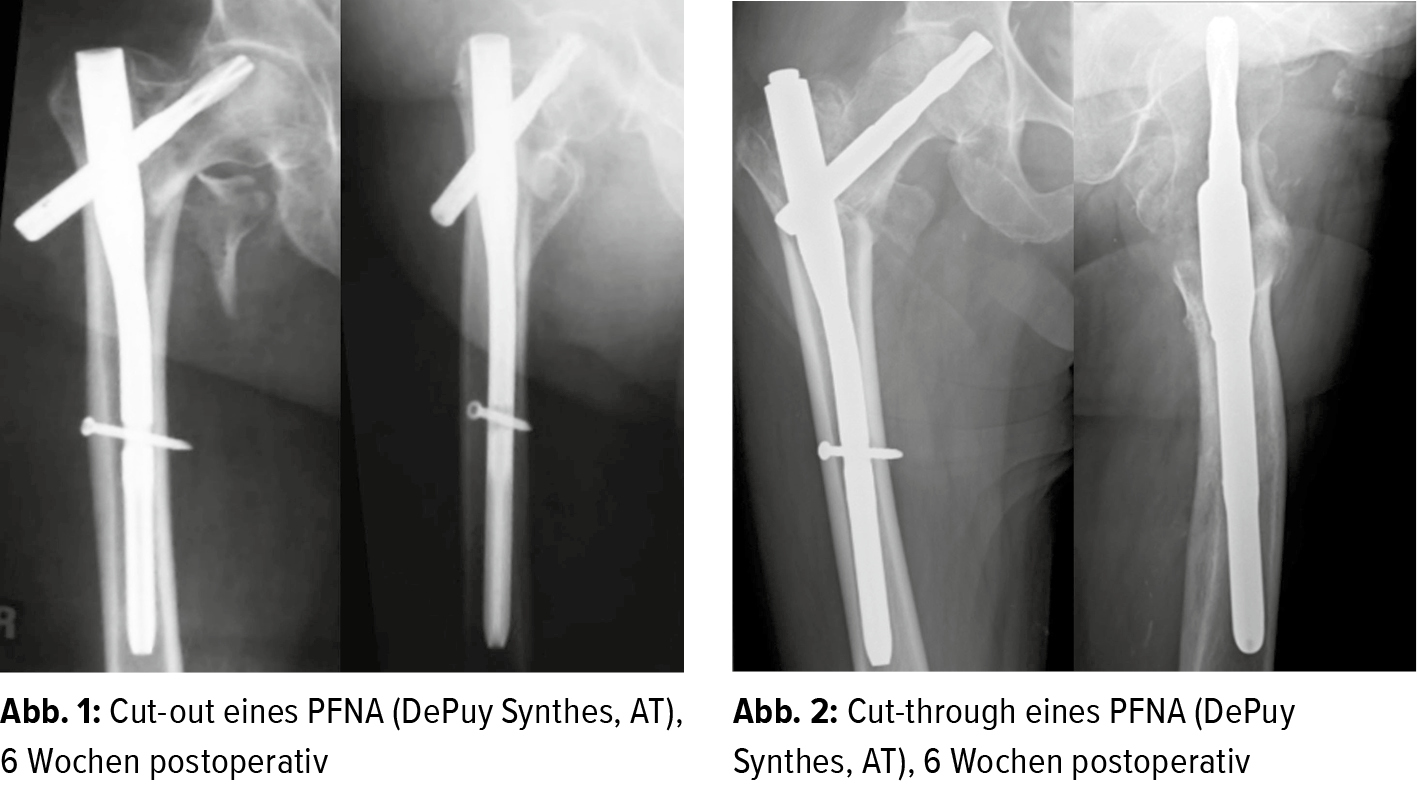 Therapieoptionen nach fehlgeschlagener Osteosynthese von Hüftfrakturen - Orthopädie ...