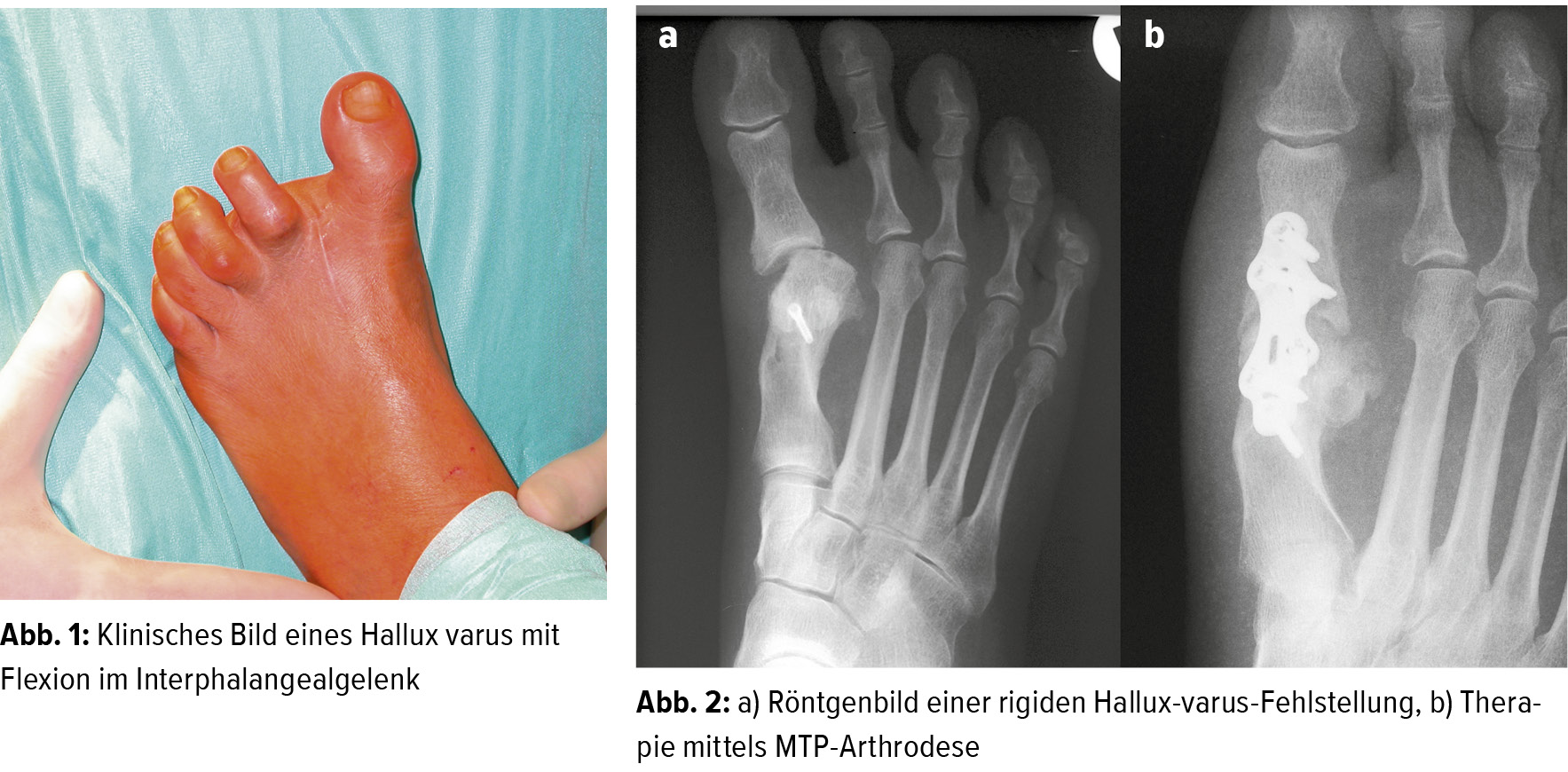 Hallux varus - Orthopädie & Traumatologie - Universimed - Knowledge ...