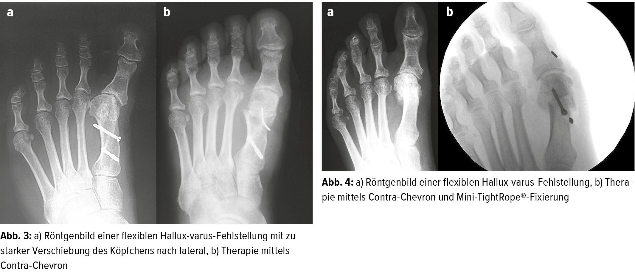 Hallux varus - Orthopädie & Traumatologie - Universimed - Knowledge ...