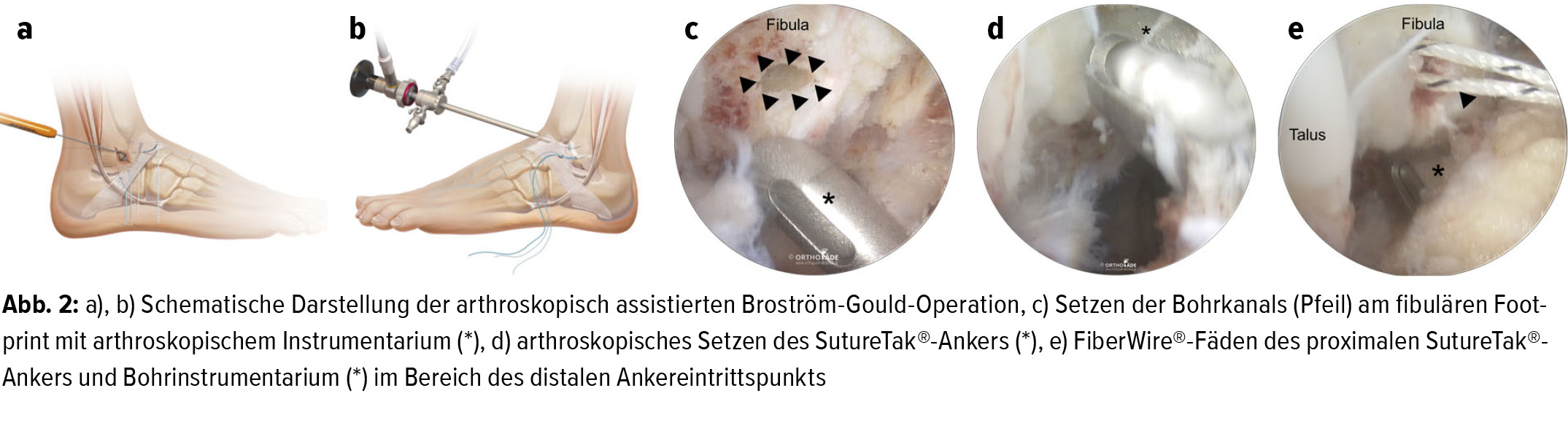 Stellenwert der Arthroskopie bei Bandinstabilität des OSG - Orthopädie ...