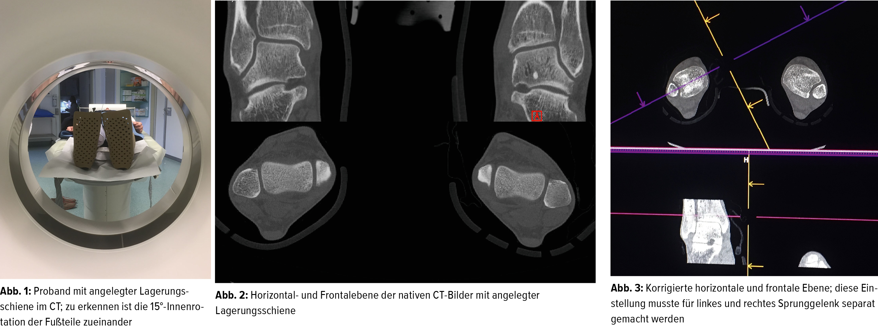 Lagerungsschiene zur Syndesmosenbeurteilung im CT - Orthopädie ...