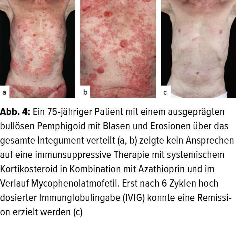 Blasenbildende Autoimmundermatosen: eine Übersicht - Dermatologie ...