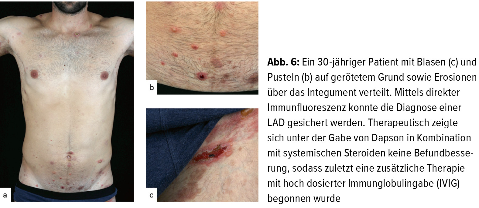 Blasenbildende Autoimmundermatosen: eine Übersicht - Dermatologie ...