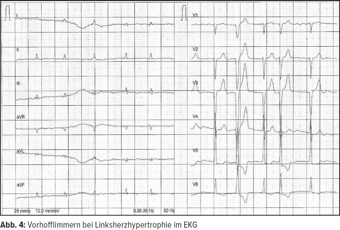 Vorhofflimmern - Kardiologie & Gefäßmedizin - Universimed - Knowledge ...