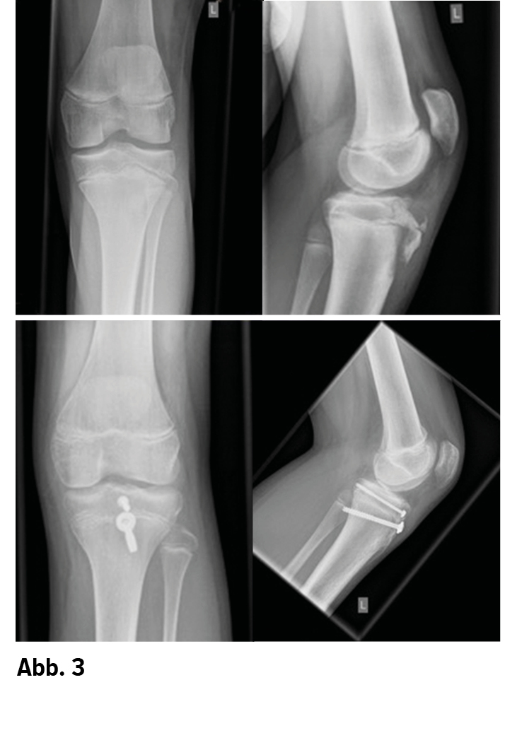 Frakturen rund um das Kniegelenk im Wachstumsalter - Orthopädie & Traumatologie - Universimed ...