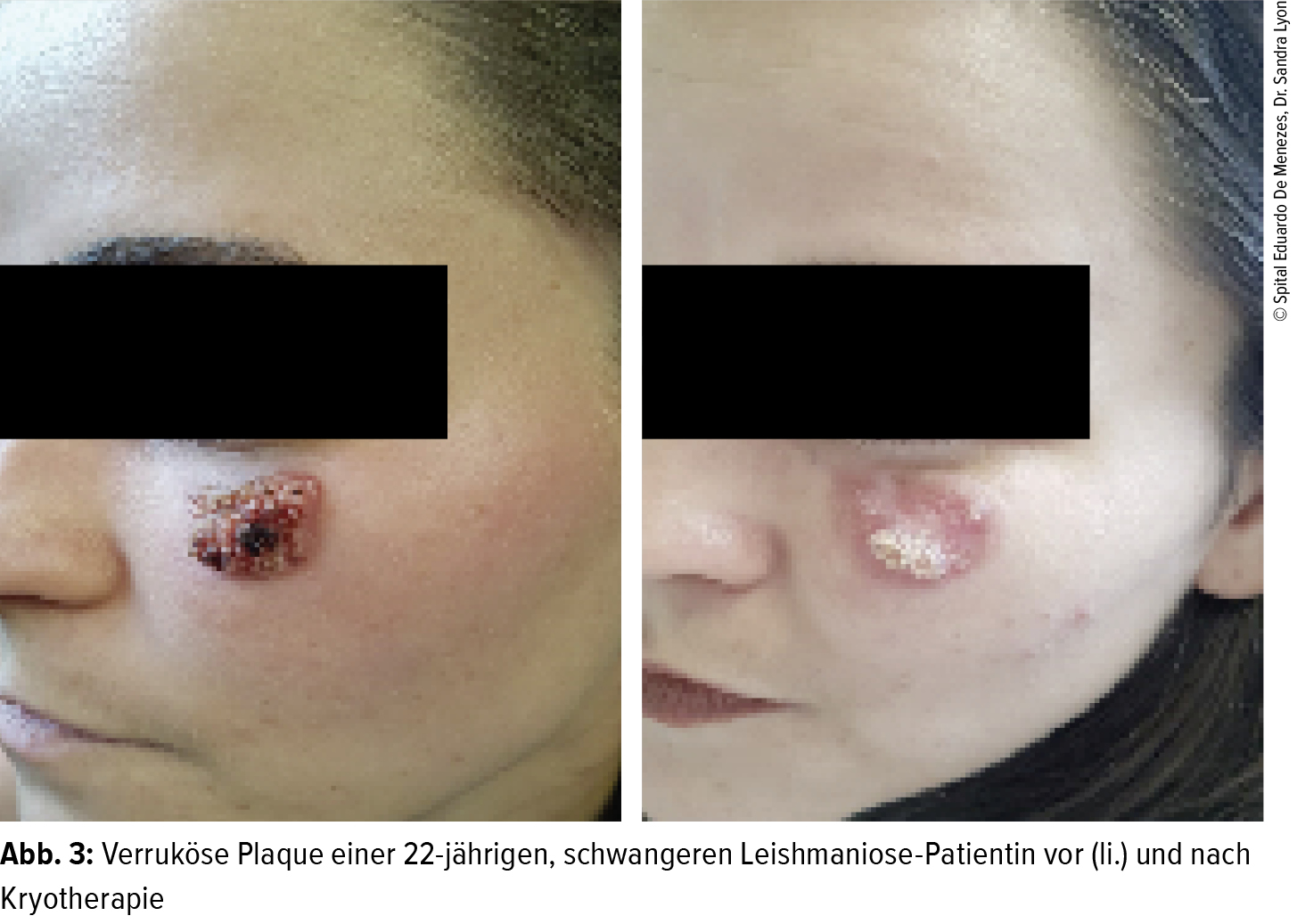 Von Lepra bis Leishmaniose - Dermatologie - Universimed - Medizin im Fokus