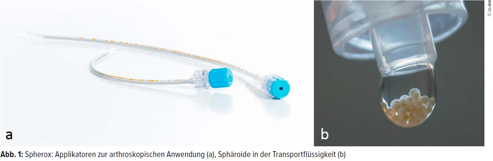 Spherox: die arthroskopische Knorpelzelltransplantation - Orthopädie ...