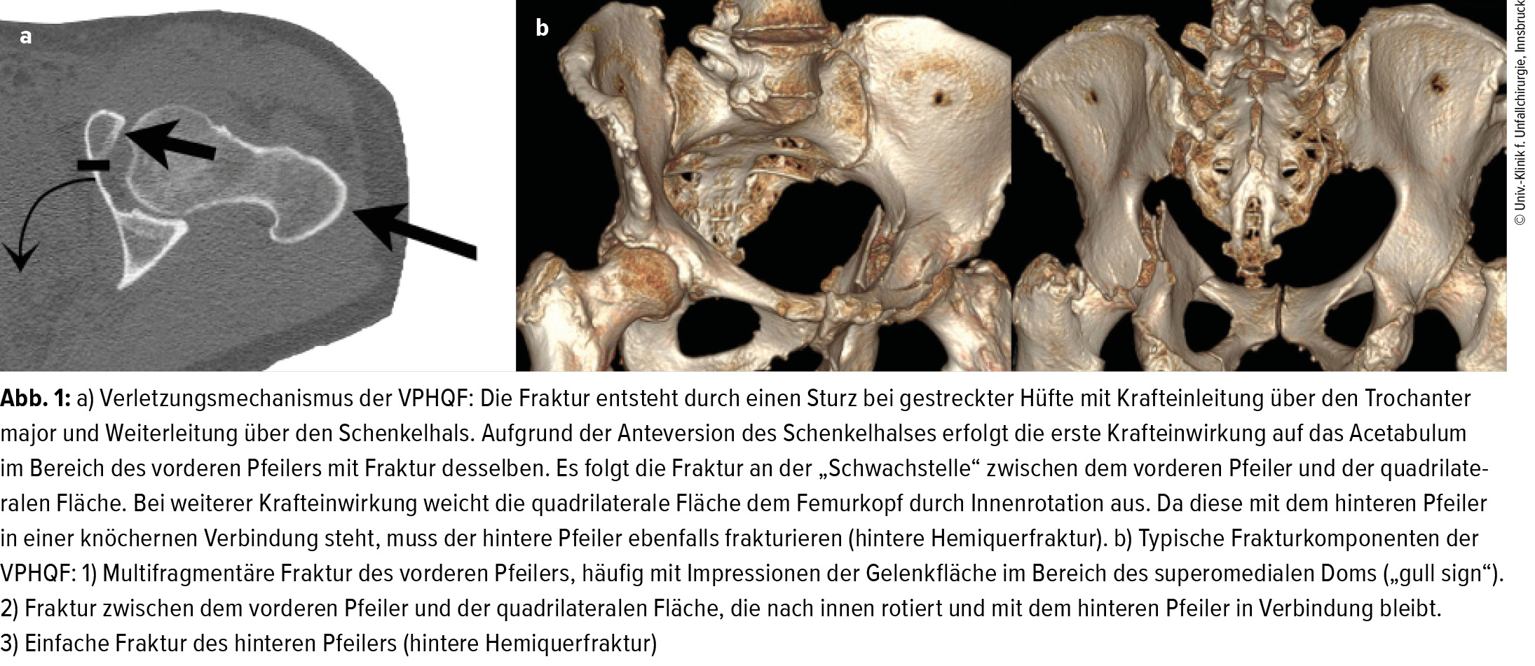 Das Konzept der pfeilerkreuzenden Zugschrauben in der Osteosynthese von ...